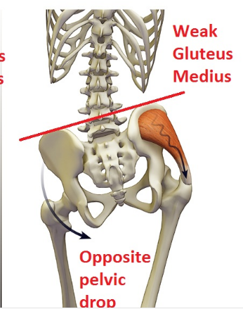 Prevalence of Gluteus Medius Weakness with Nonspecific Low Back Pain